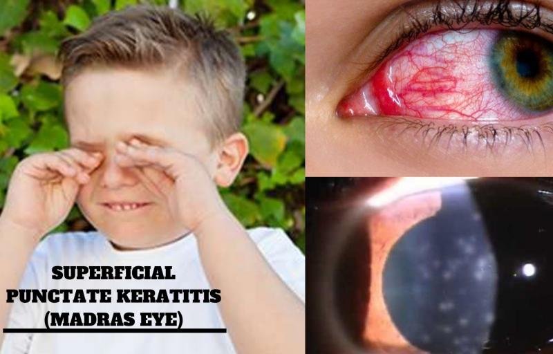SUPERFICIAL PUNCTATE KERATITIS (MADRAS EYE)
